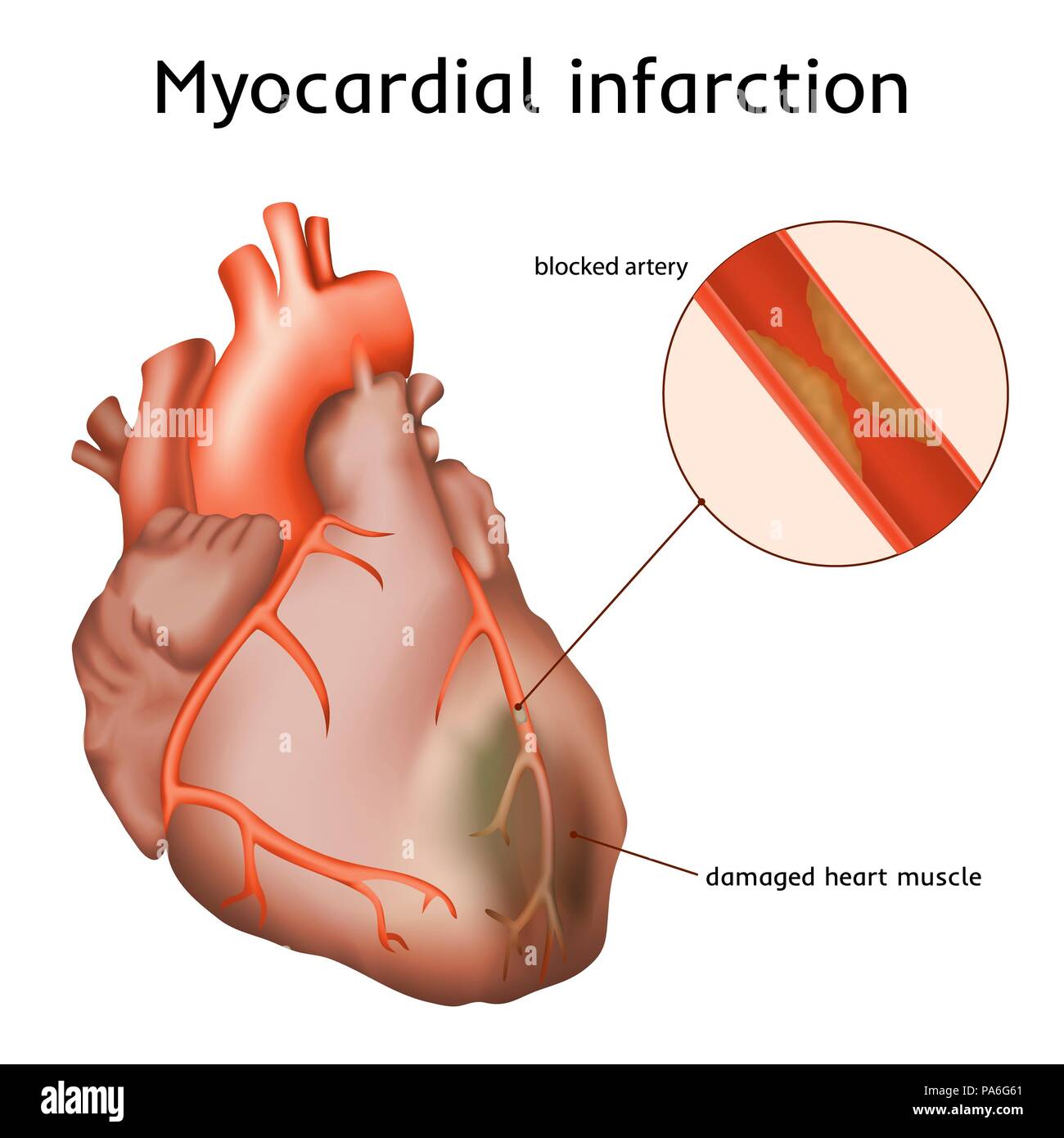 Crise cardiaque (infarctus du myocarde), de l'illustration. Le blocage ...