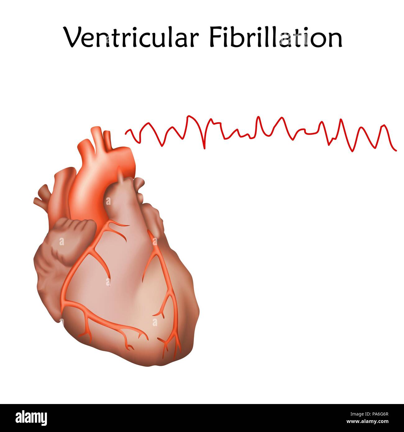 Arritmia ventricular Banque de photographies et d’images à haute ...