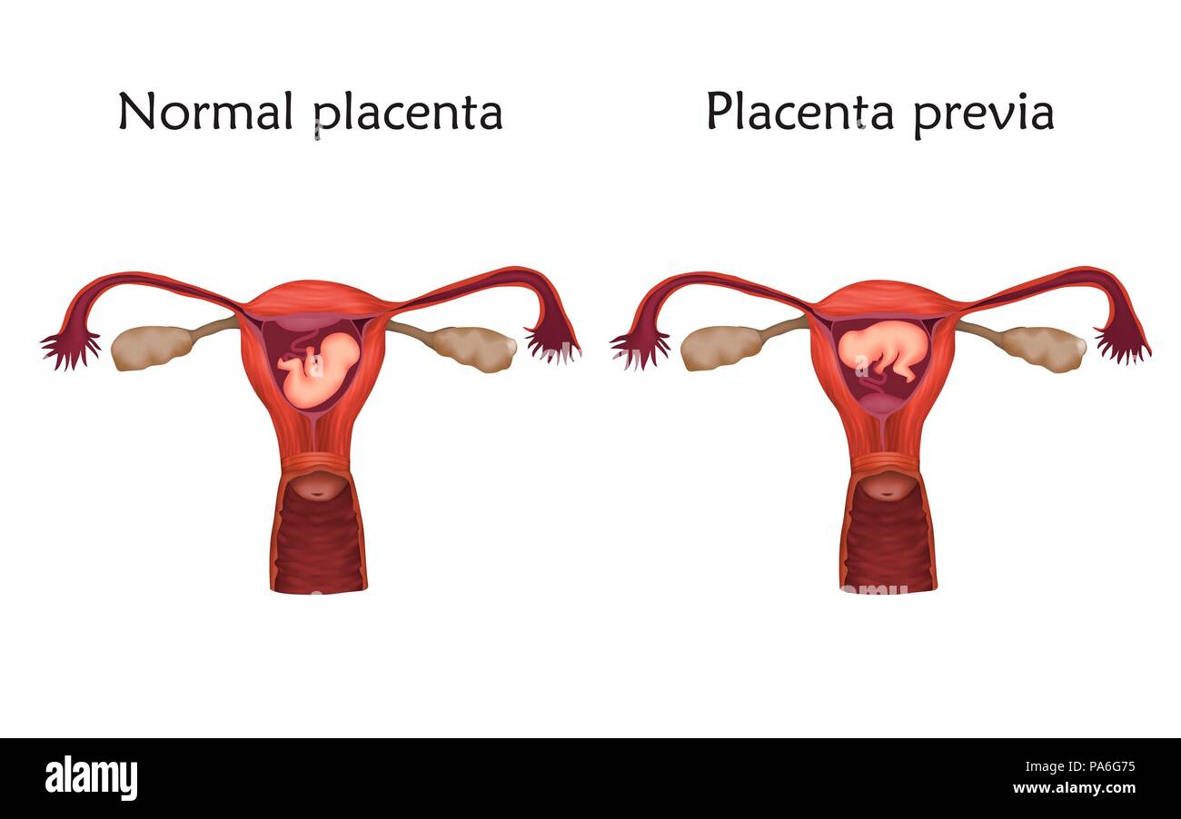 Le previa de placenta et grossesse normale comparaison, illustration ...