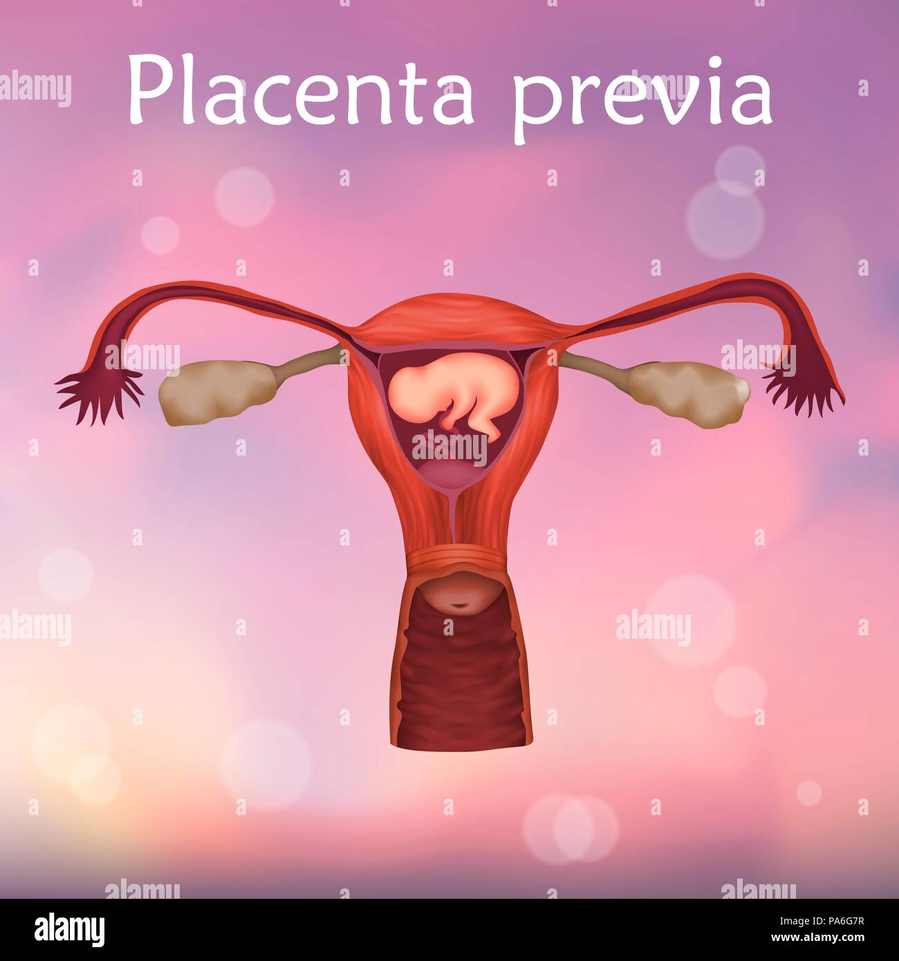 Placenta praevia Banque de photographies et d’images à haute résolution ...
