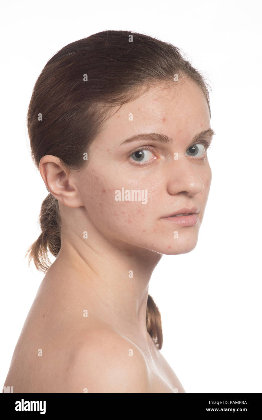 Tache Rouge Peau Sur Cicatrice Banque d'image et photos - Alamy