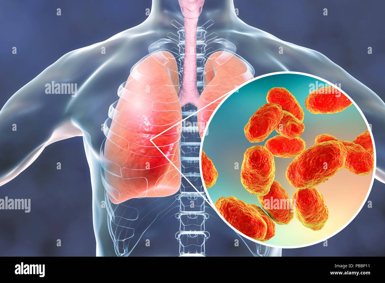 La pneumonie causée par la bactérie Haemophilus influenzae ...