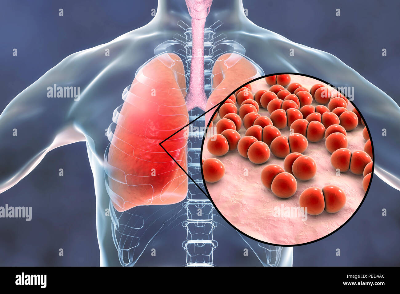 La pneumonie causée par la bactérie Streptococcus pneumoniae ...