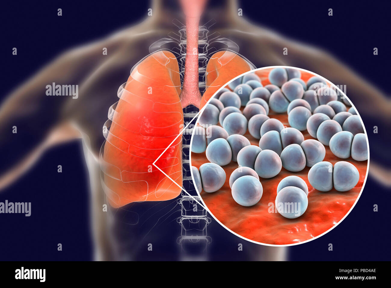 Gram Positive Streptococcus Pneumoniae Banque d'image et photos - Alamy