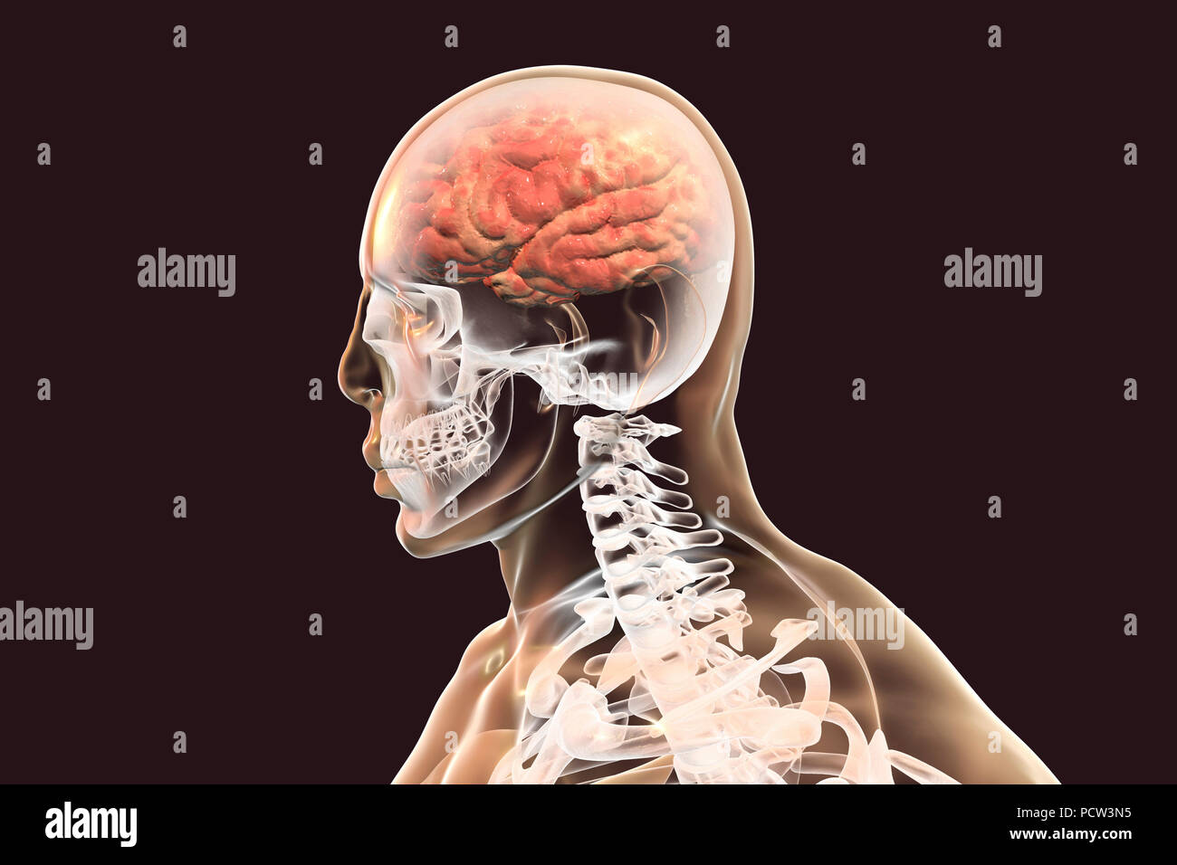 Cerveau avec l'encéphalite. Illustration de l'ordinateur cerveau avec ...