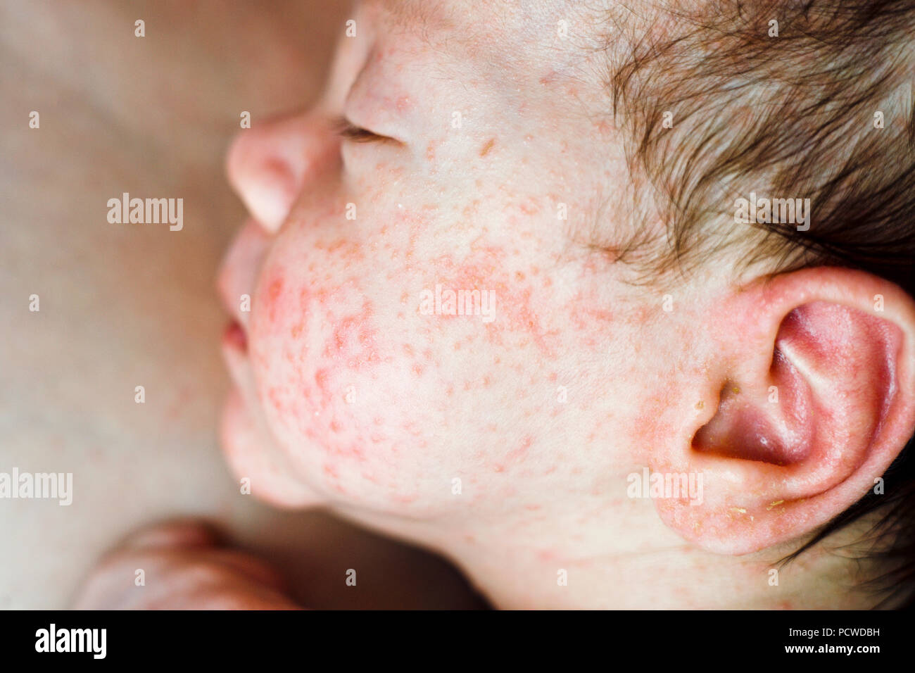 Eczéma atopique Banque de photographies et d’images à haute résolution ...