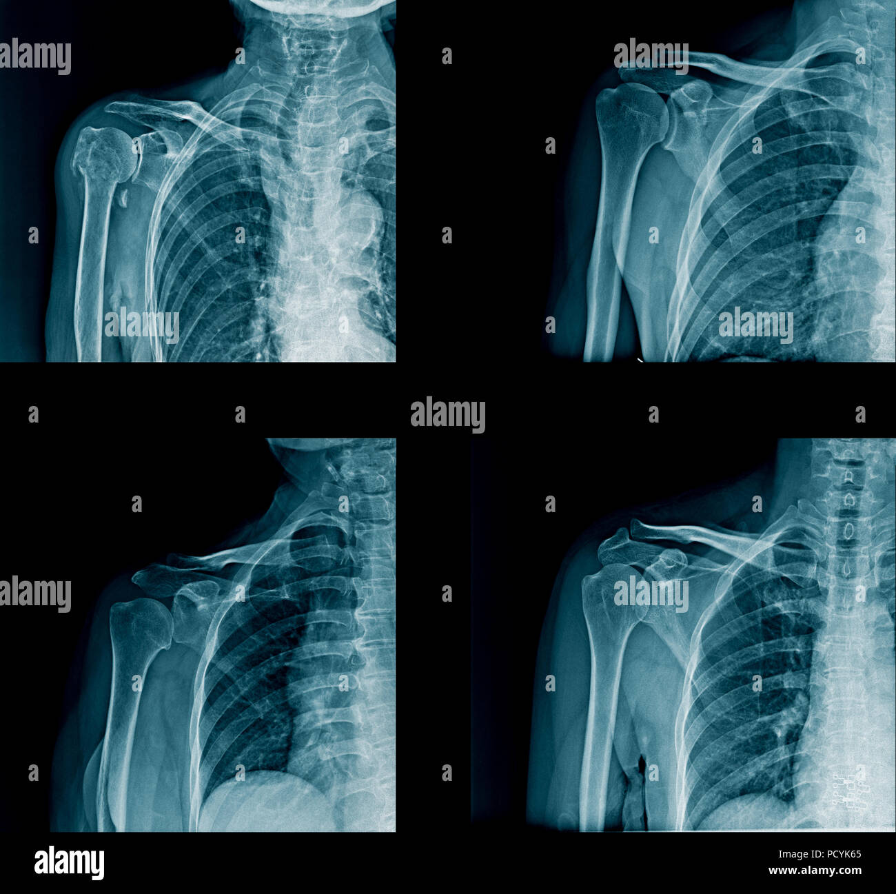 Radiographie des épaules Banque de photographies et d’images à haute ...