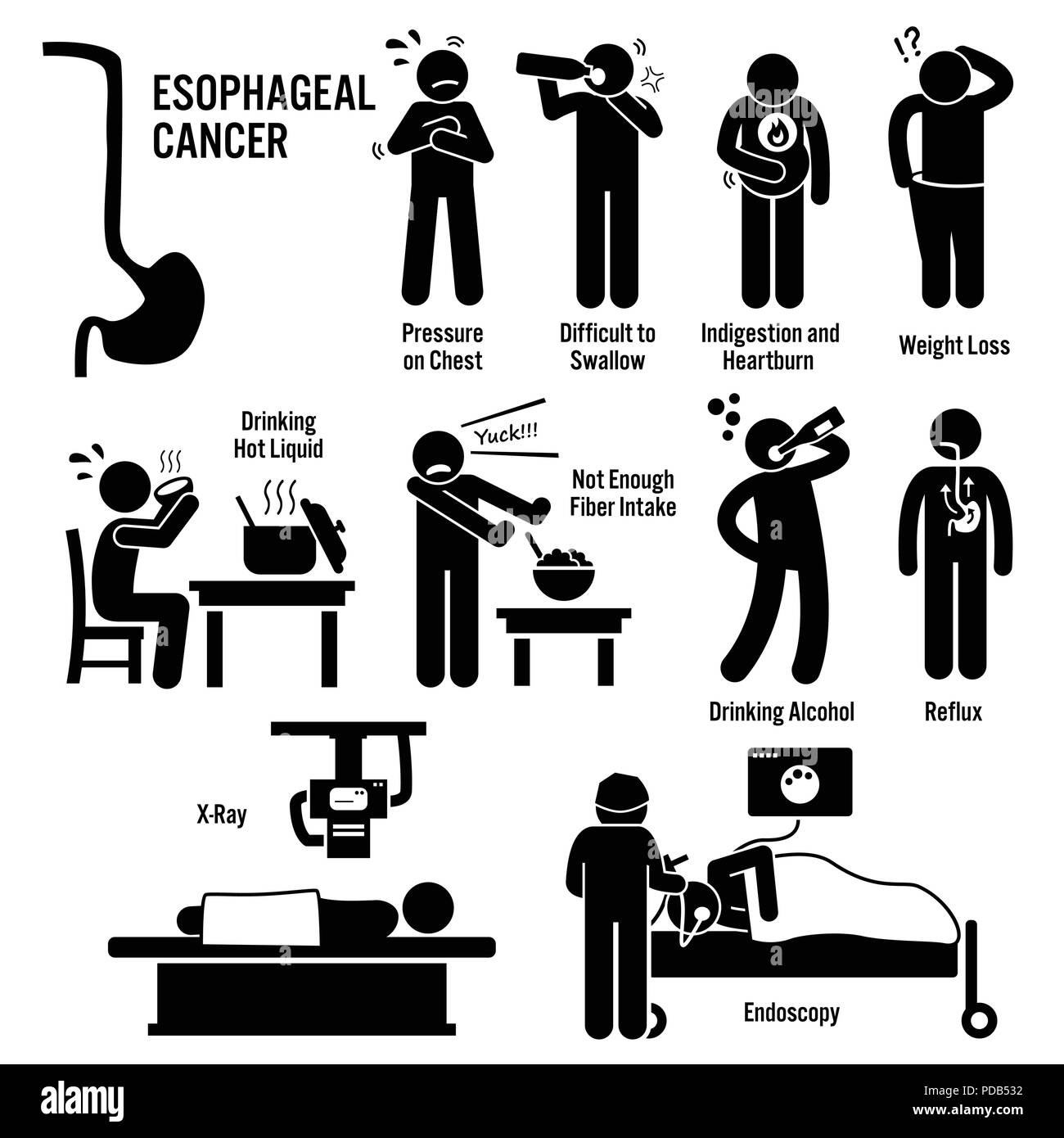 De l'oesophage l'oesophage Cancer de la gorge Symptômes Causes Facteurs de risque Diagnostic ...