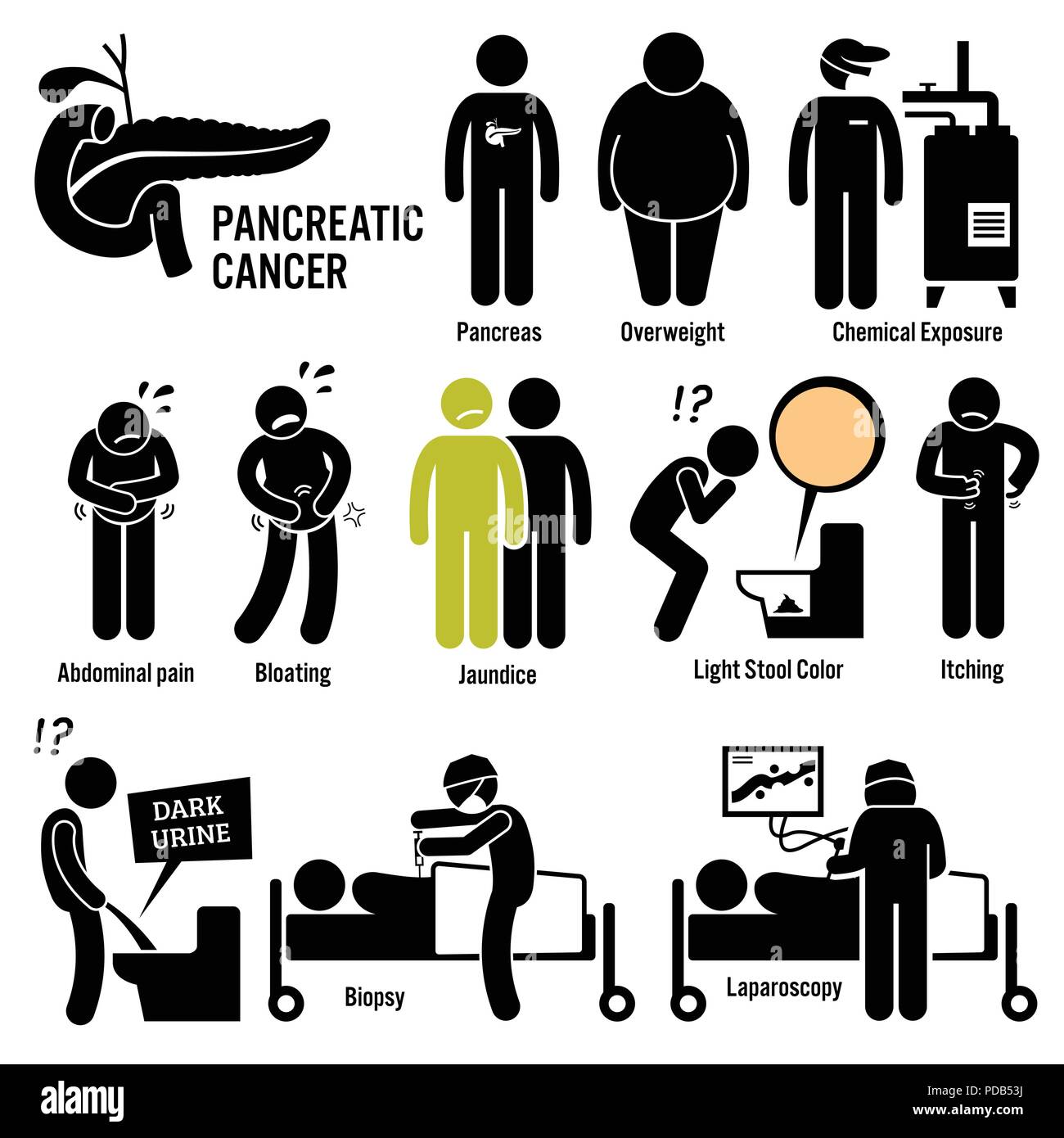 Cancer du pancréas pancréas Causes Symptômes Diagnostic Facteurs de ...