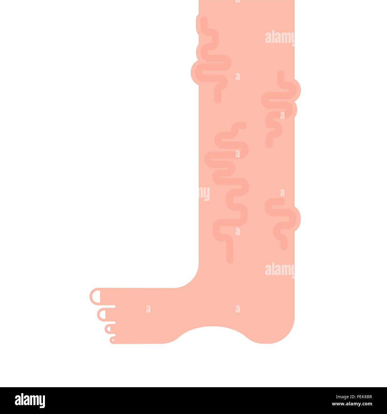 Varicose veins illustration Banque d'images vectorielles - Alamy