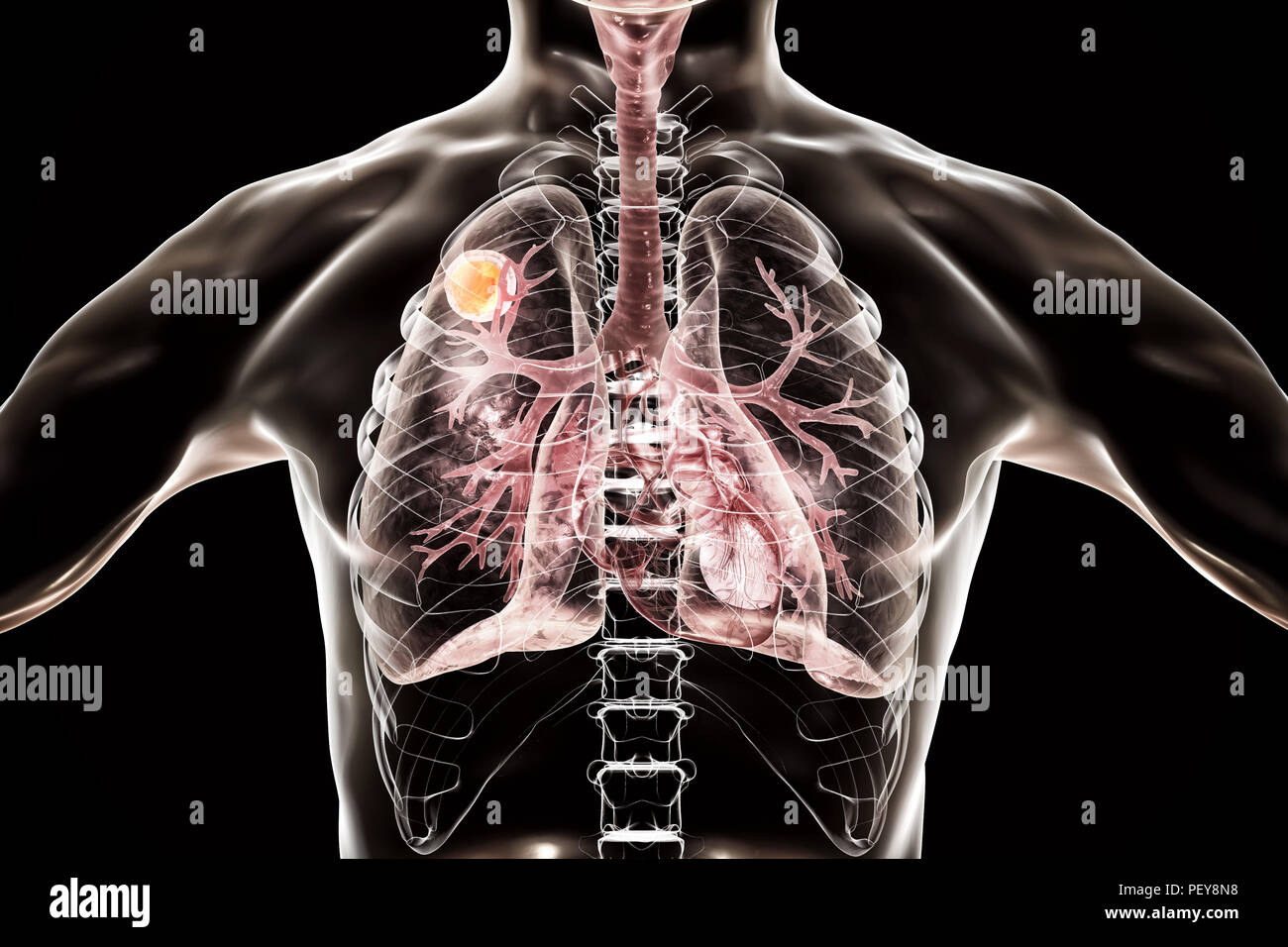 Aspergilloma du poumon, l'illustration de l'ordinateur. Aussi connu ...