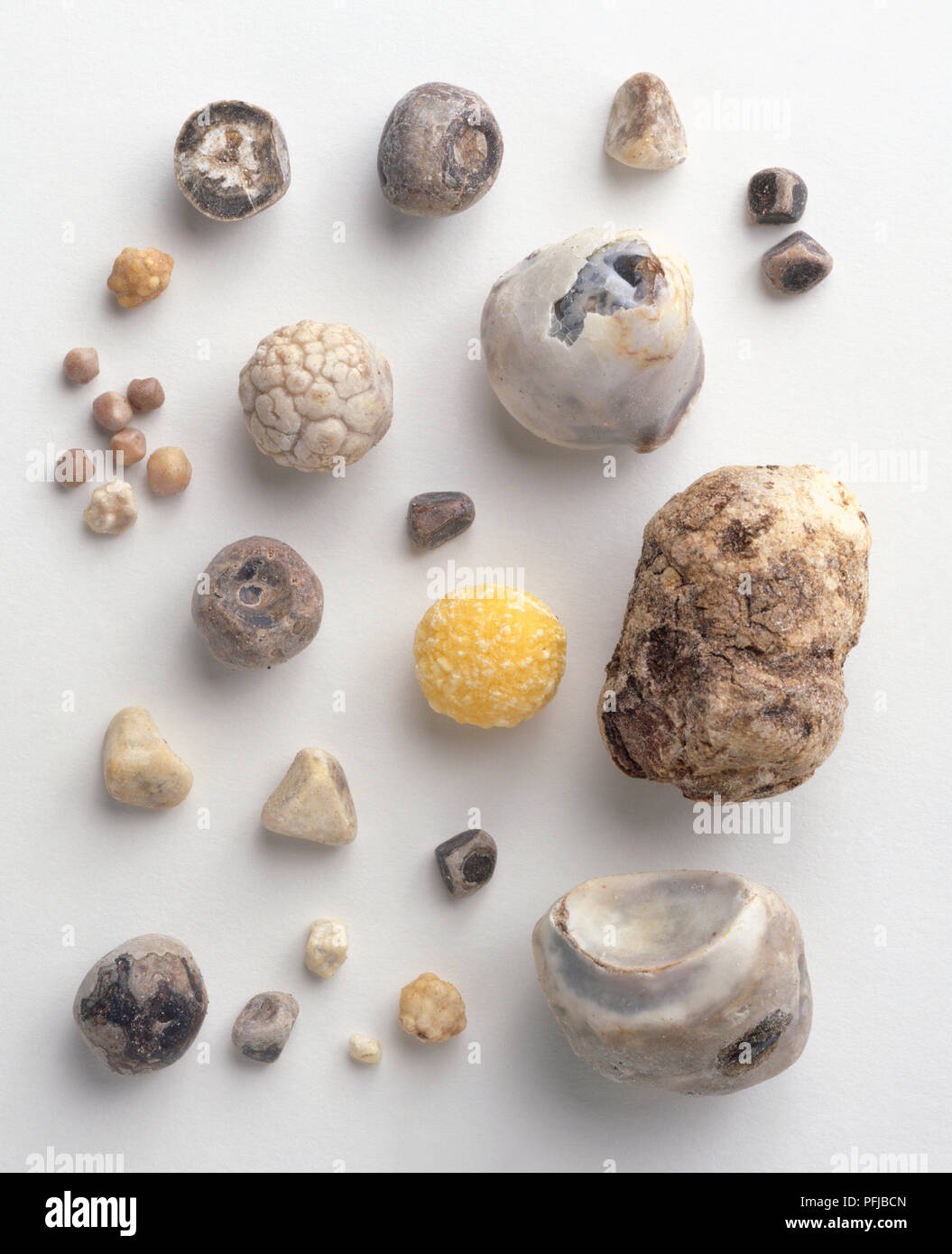 Grande collection de calculs biliaires de diverses tailles et formes ...