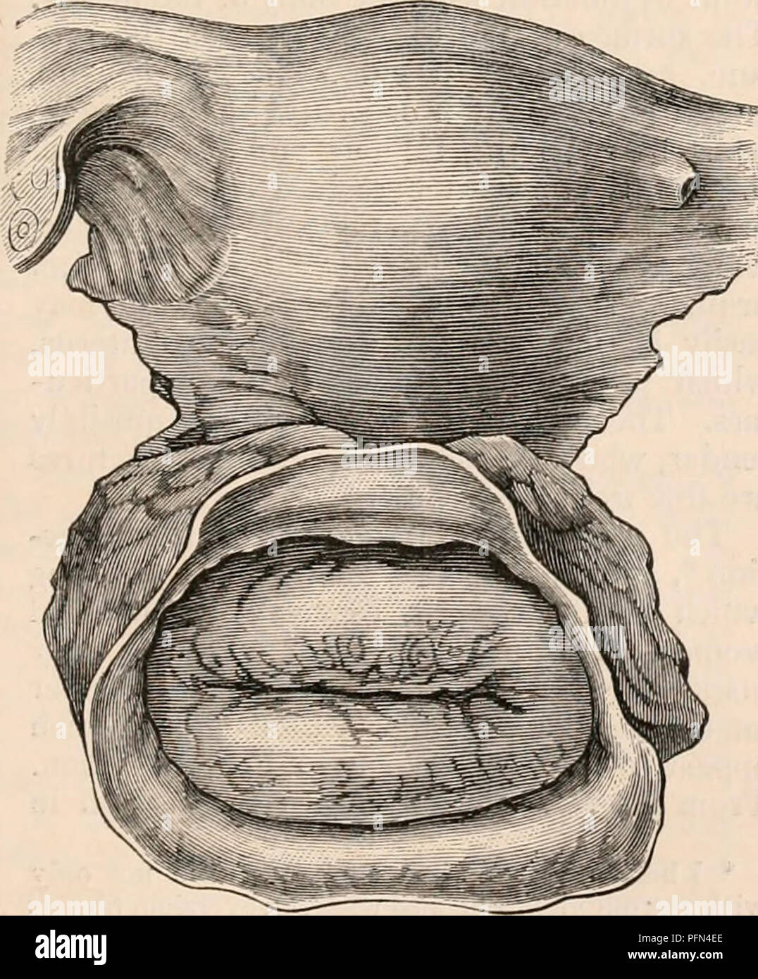Cavity of the uterus Banque de photographies et d’images à haute ...