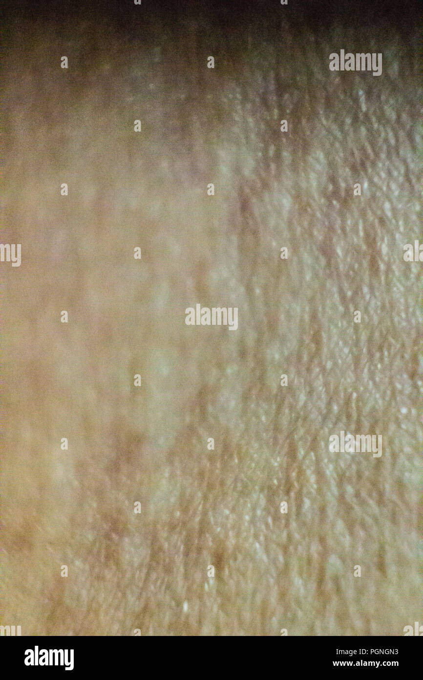 Vue rapprochée de l'urticaire au froid éruption allergique. Les ...