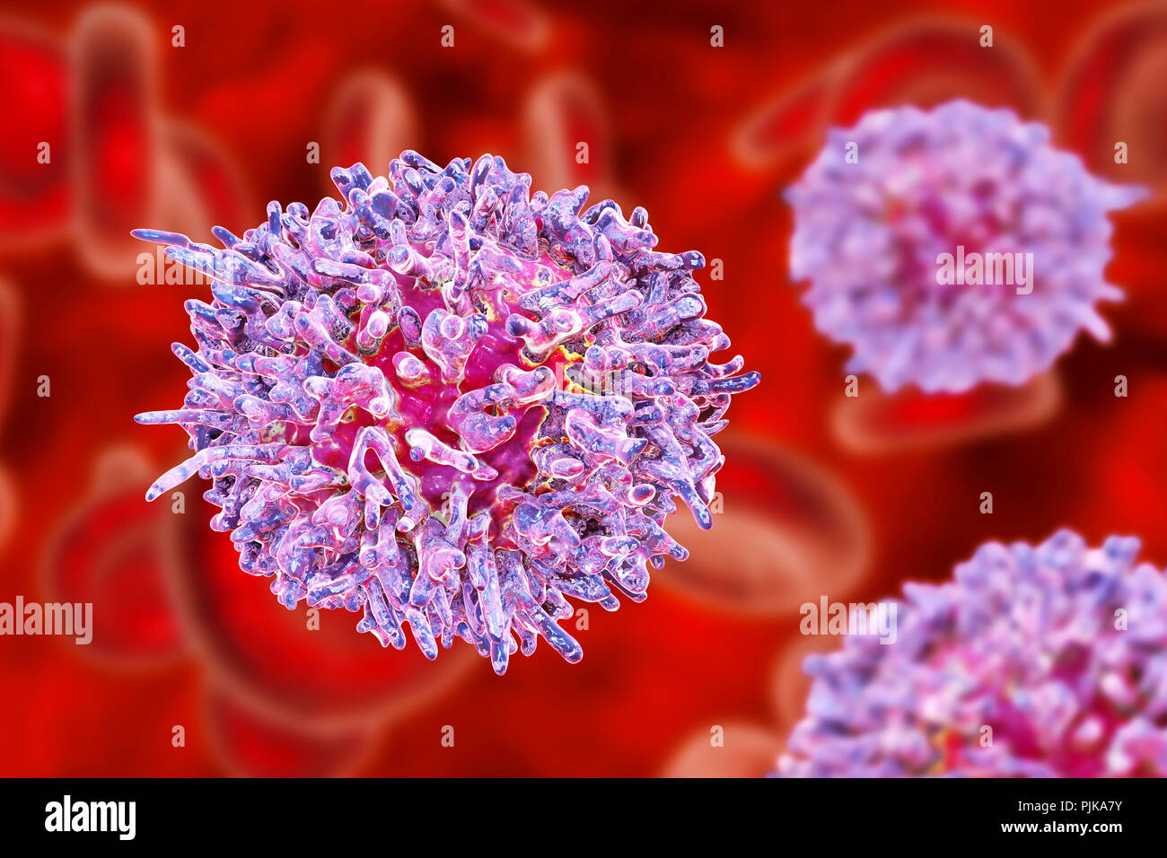 La leucémie à tricholeucocytes. Illustration d'ordinateur d'anomalies ...
