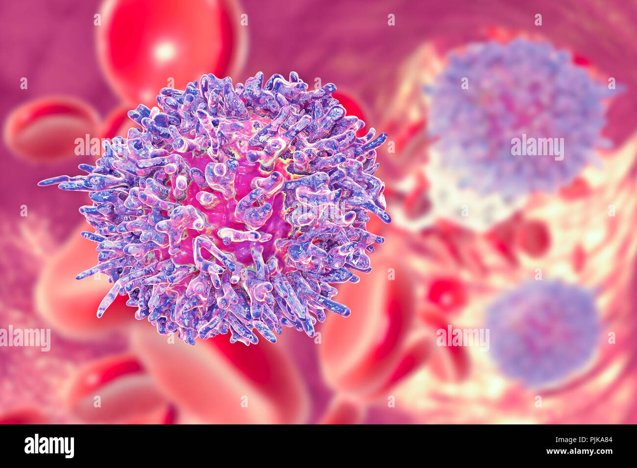 La leucémie à tricholeucocytes. Illustration d'ordinateur d'anomalies ...
