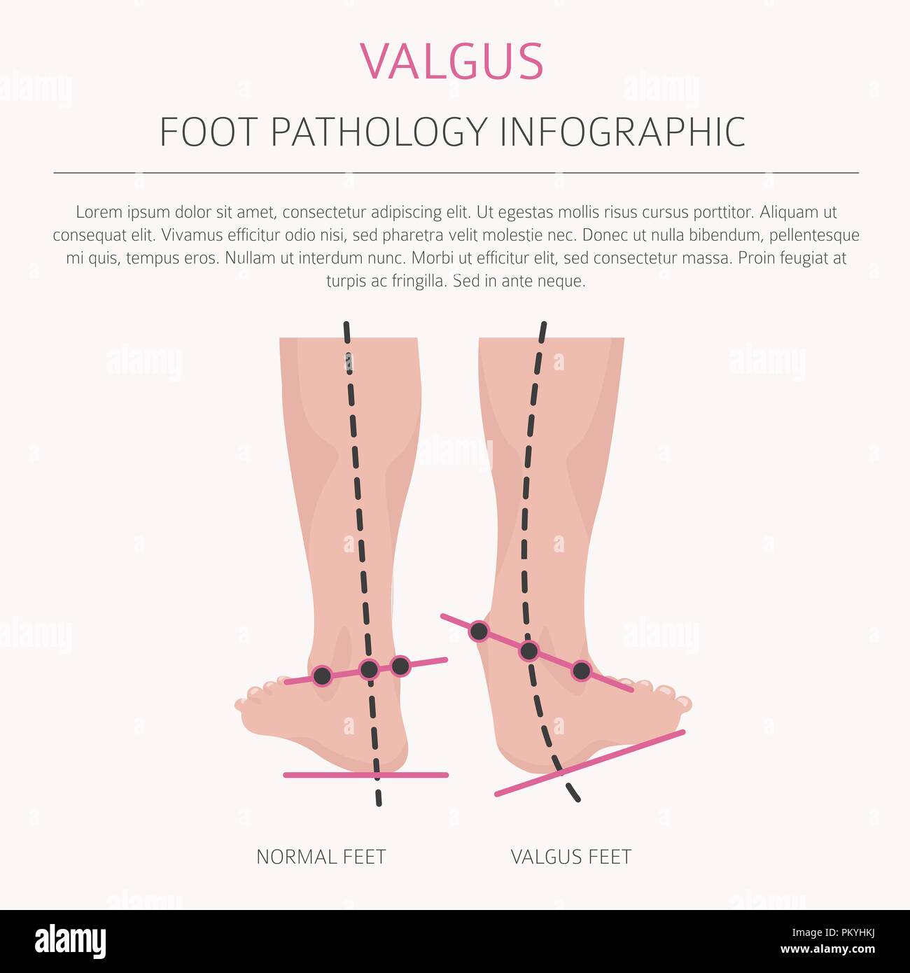 La déformation du pied en tant que maladie médicale infographie. Varus ...