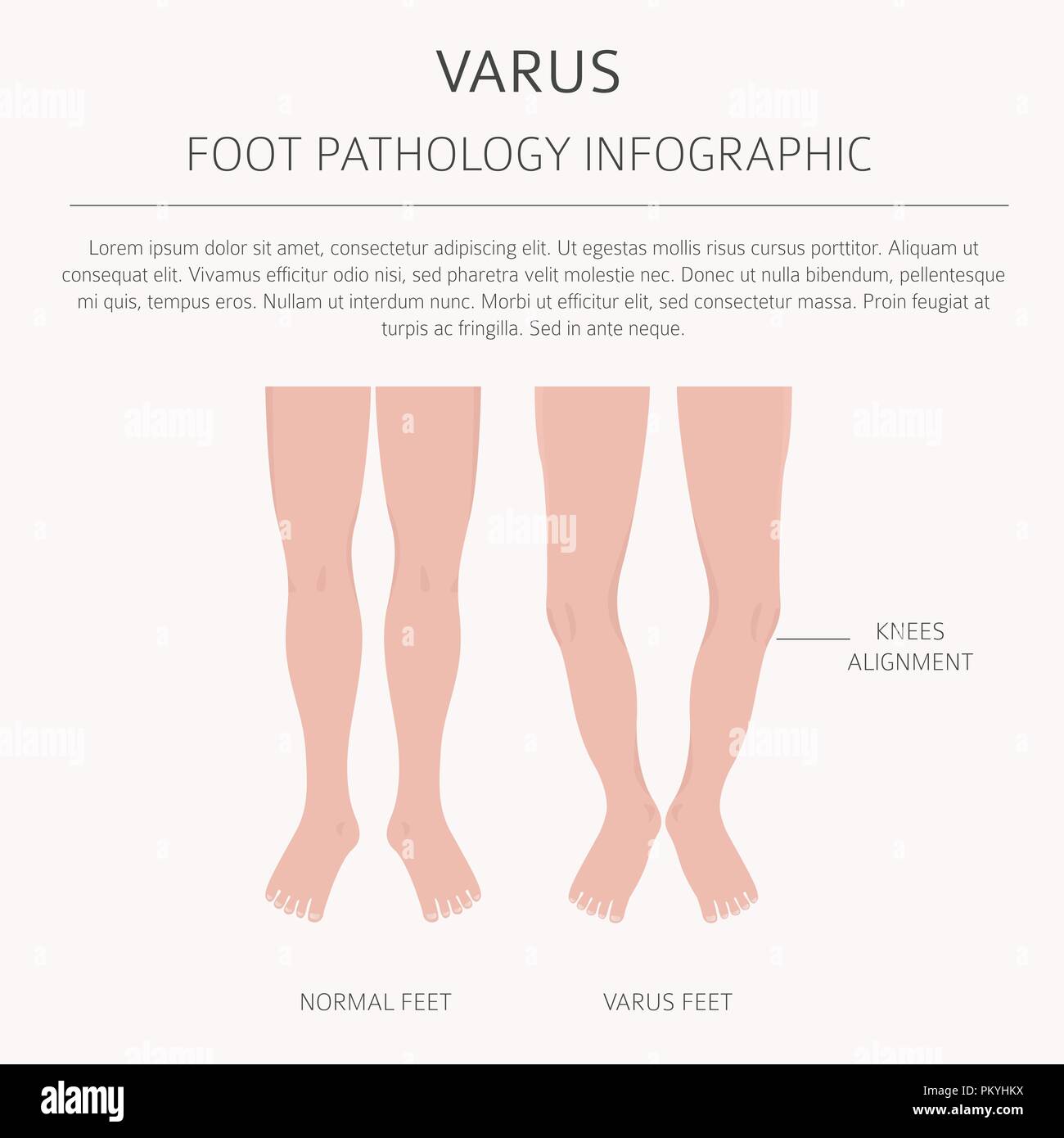 La déformation du pied en tant que maladie médicale infographie. Varus ...
