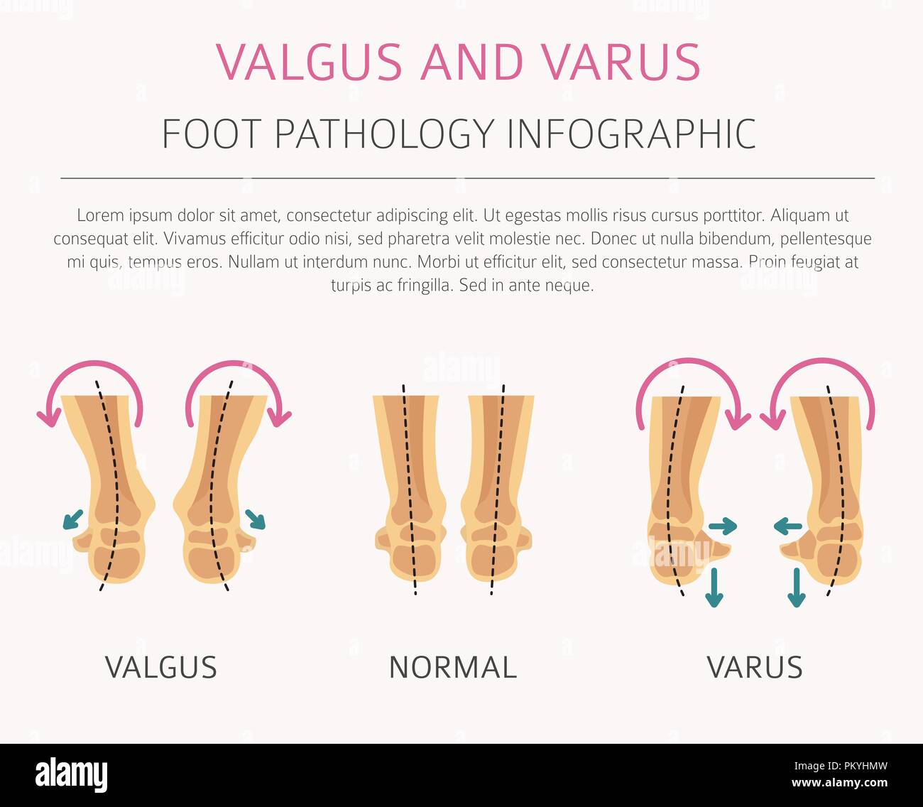 Varus valgus Banque d'images vectorielles - Alamy