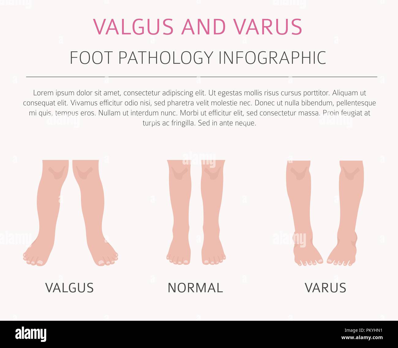 Varus valgus Banque de photographies et d’images à haute résolution - Alamy