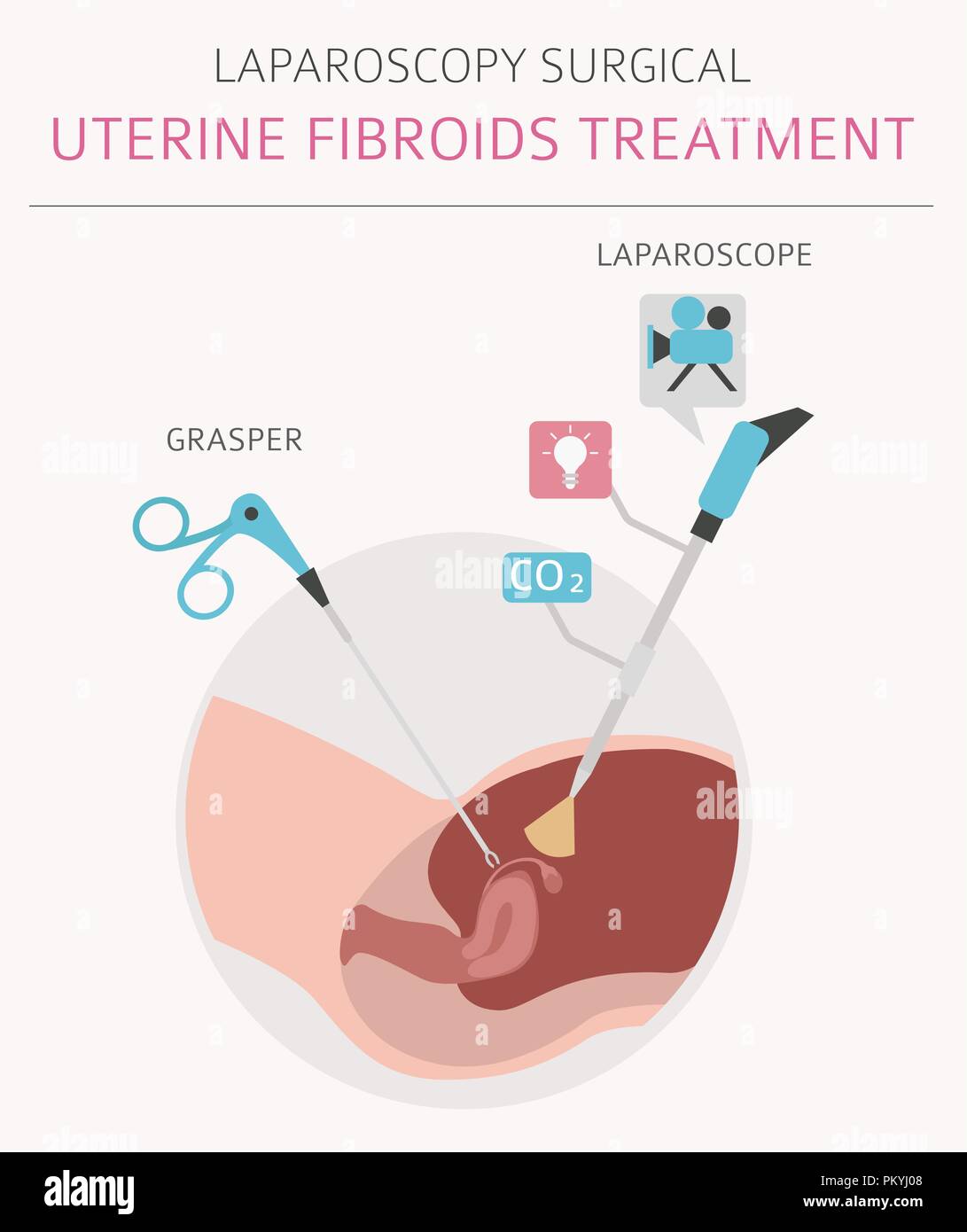 Les fibromes utérins. Ginecological maladie médicale chez les femmes ...