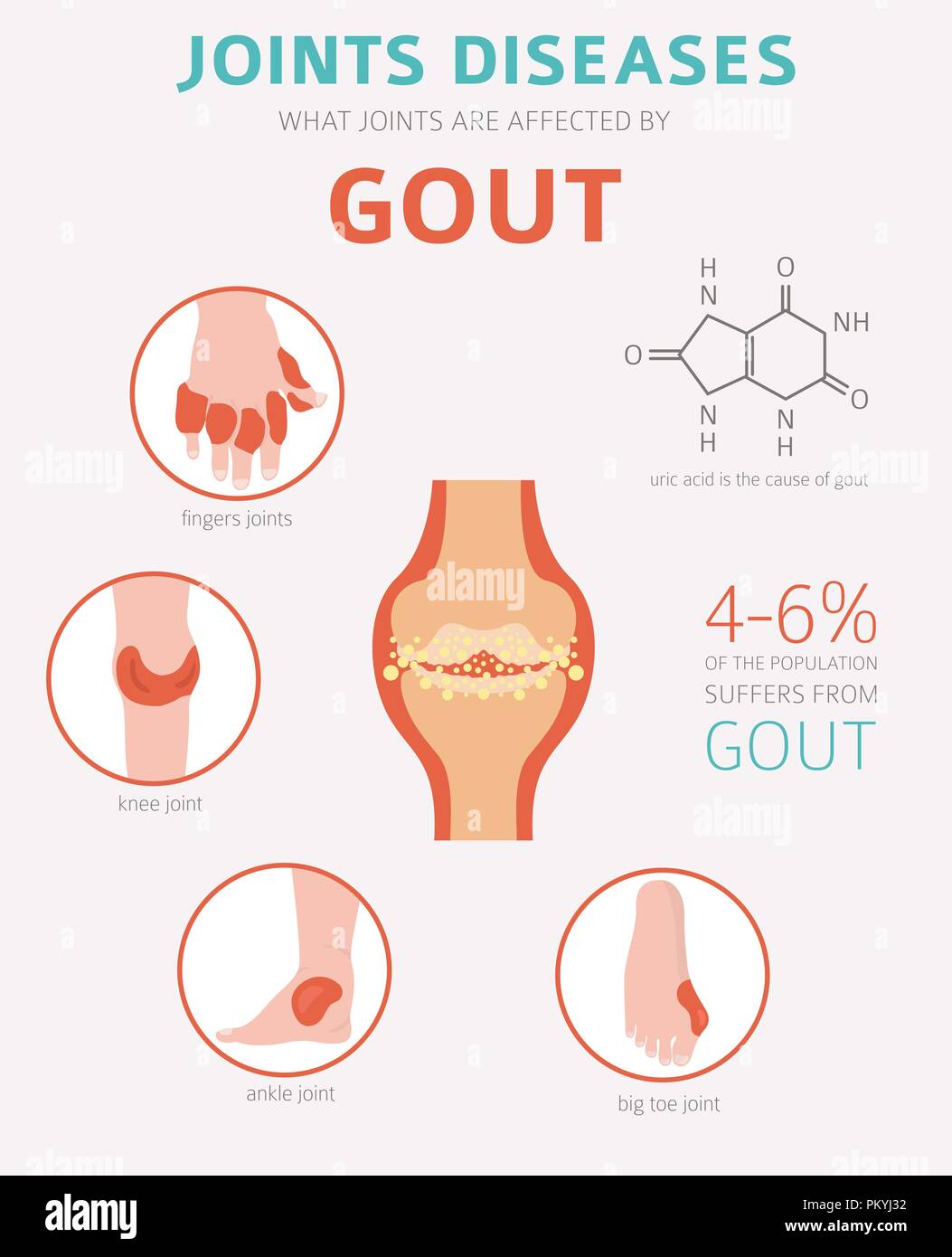 Des maladies des articulations. La goutte, symptômes, traitement icon ...