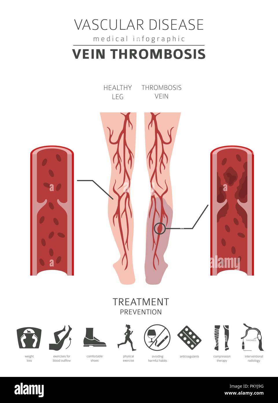 Les maladies vasculaires. Thromboses veineuses symptômes, traitement ...