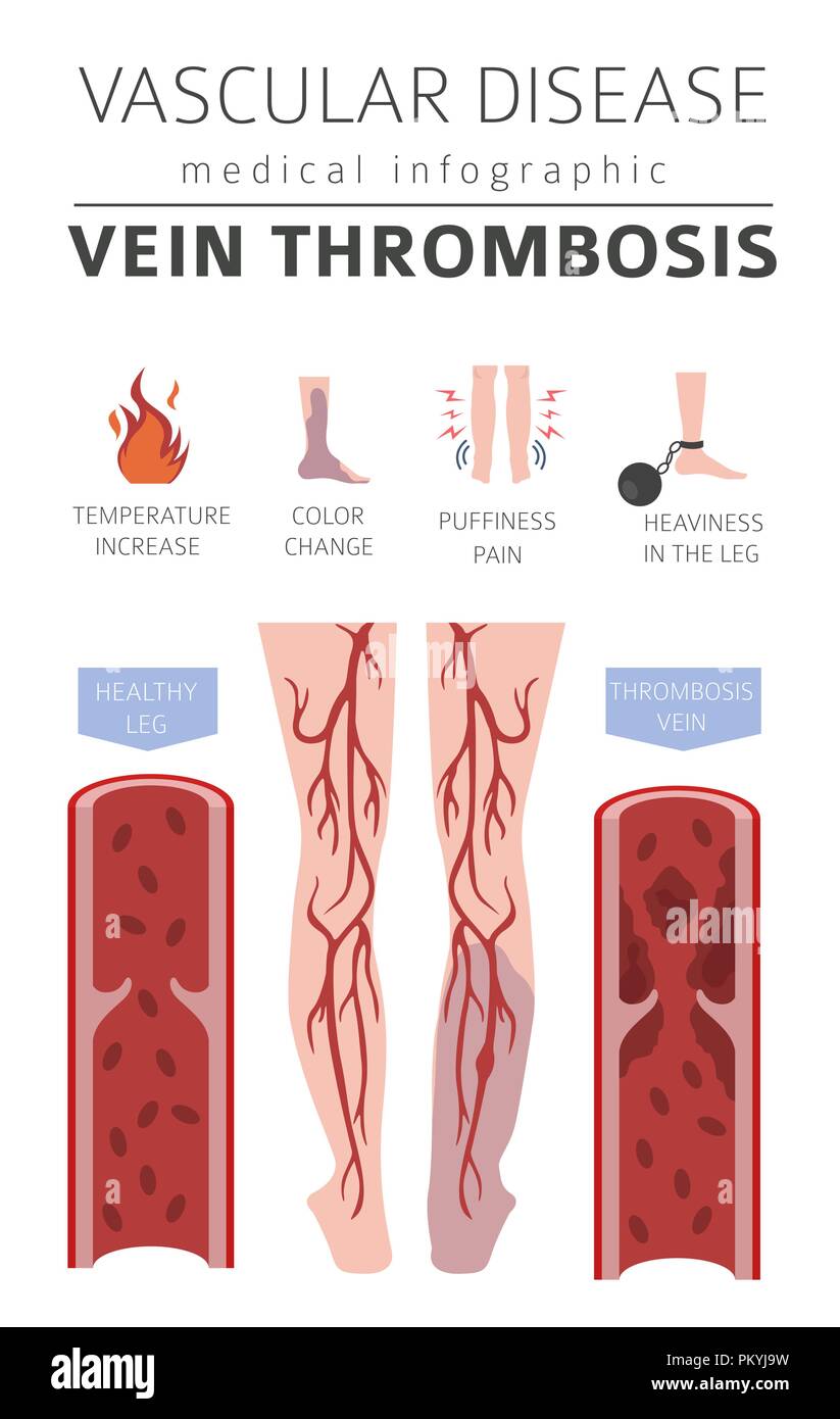 Thrombose veineuse Banque de photographies et d’images à haute ...