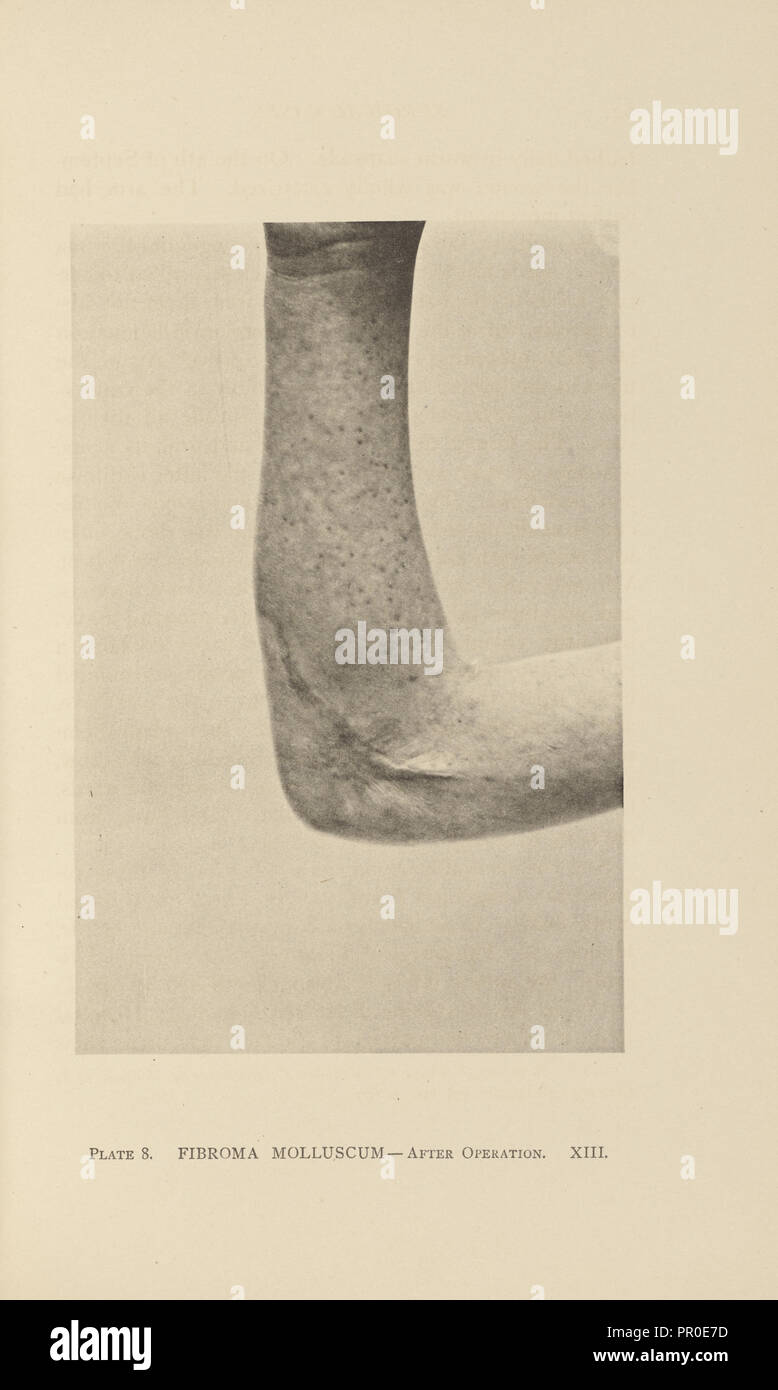 Fibroma molluscum Banque de photographies et d’images à haute ...