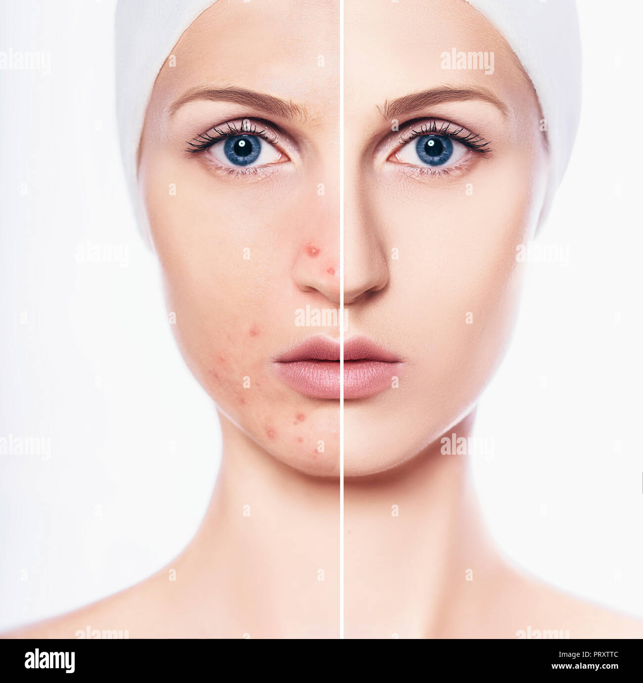 Acne before and after Banque de photographies et d’images à haute ...
