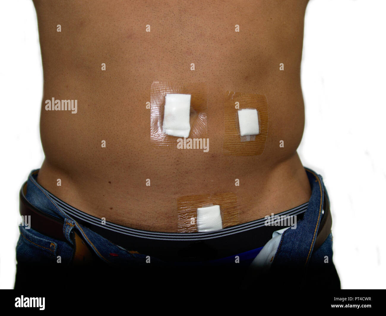 Les domaines d'entrée bandée appendicectomie laparoscopique chirurgie ...