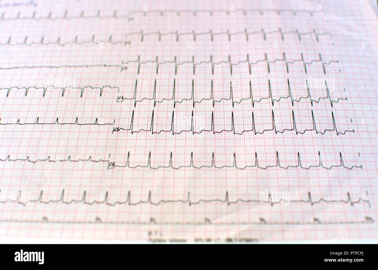 Electrocardiograma en papel Banque de photographies et d’images à haute ...