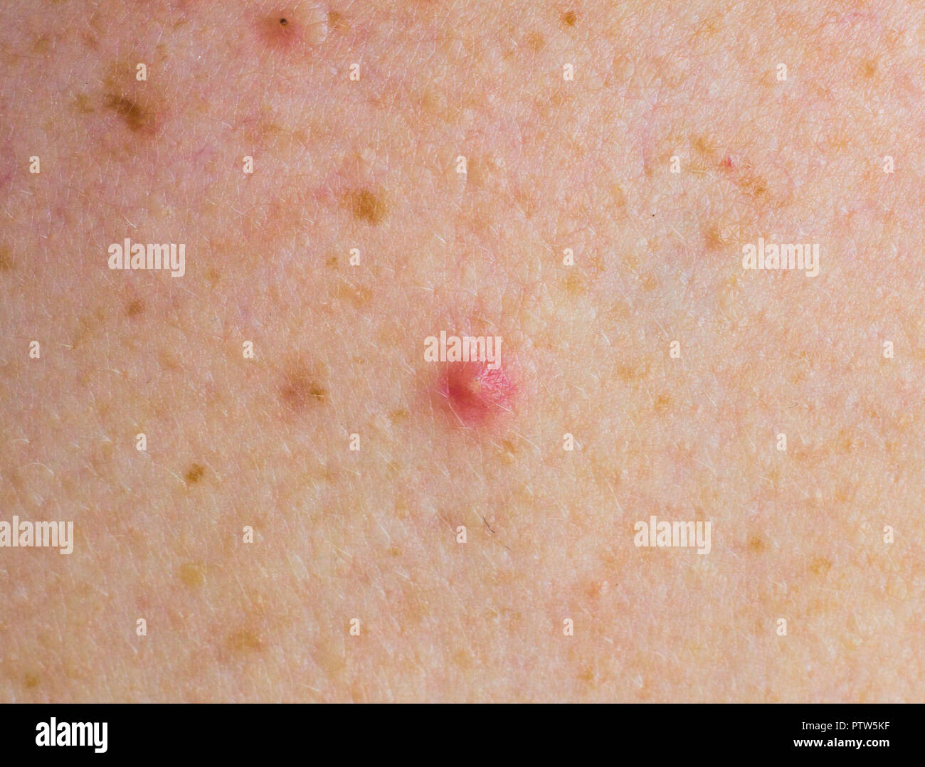 Tache rouge peau sur cicatrice Banque de photographies et d’images à ...
