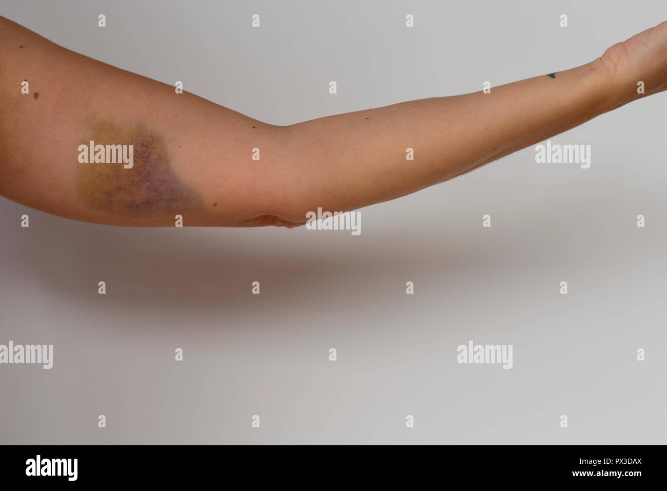 Hematoma arm Banque de photographies et d’images à haute résolution - Alamy