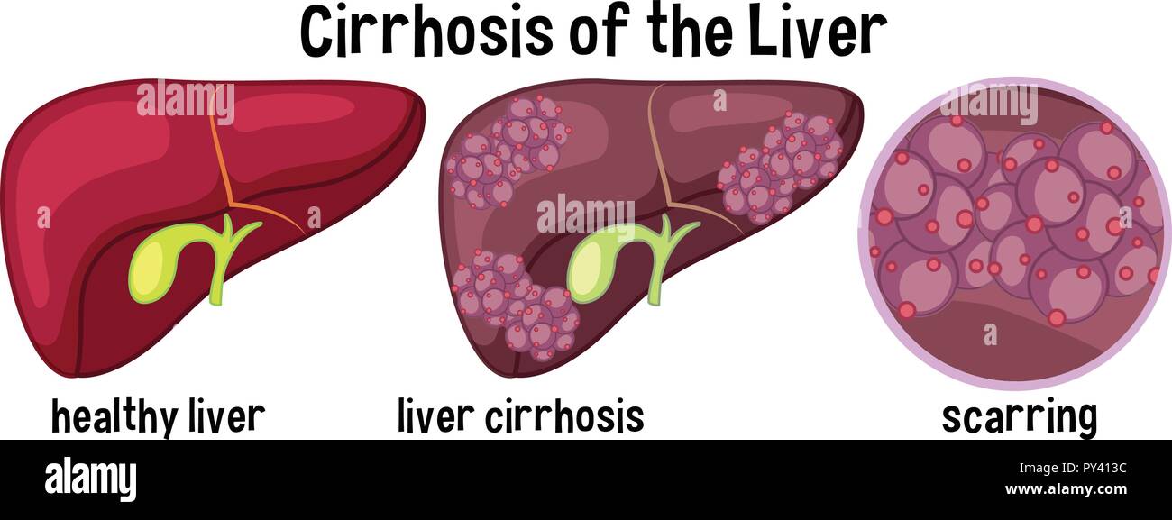 La cirrhose du foie illustration Image Vectorielle Stock - Alamy