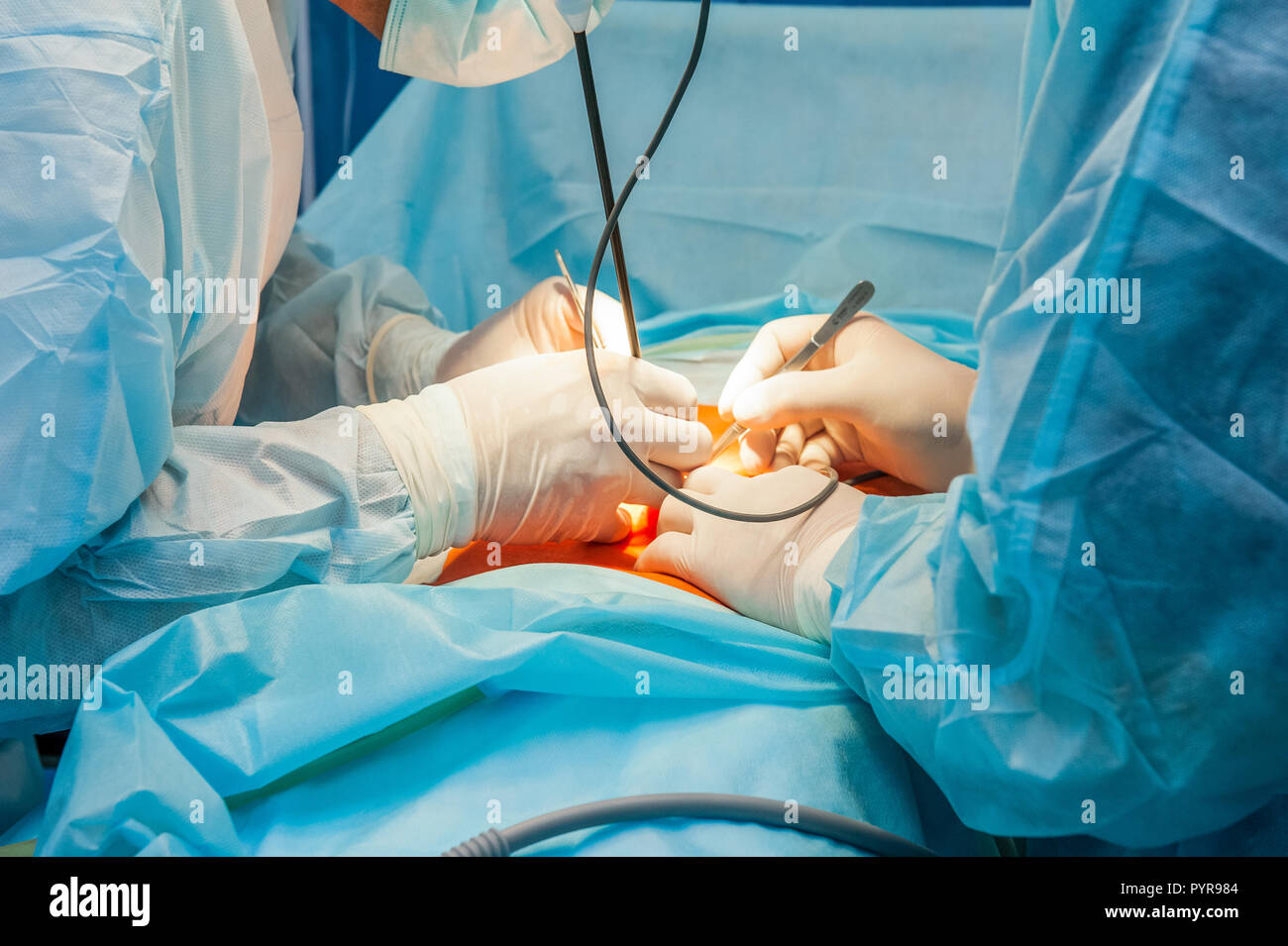 Sur une opération par laparoscopie complexe cavité péritonéale est ...