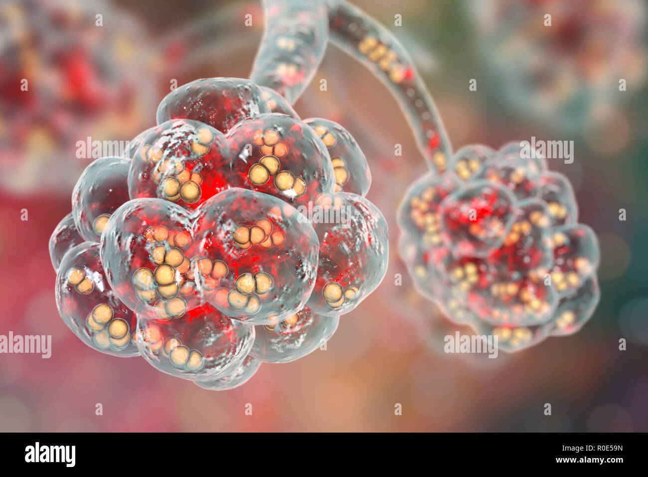 La pneumonie à pneumocoques. Illustration d'ordinateur de Streptococcus ...