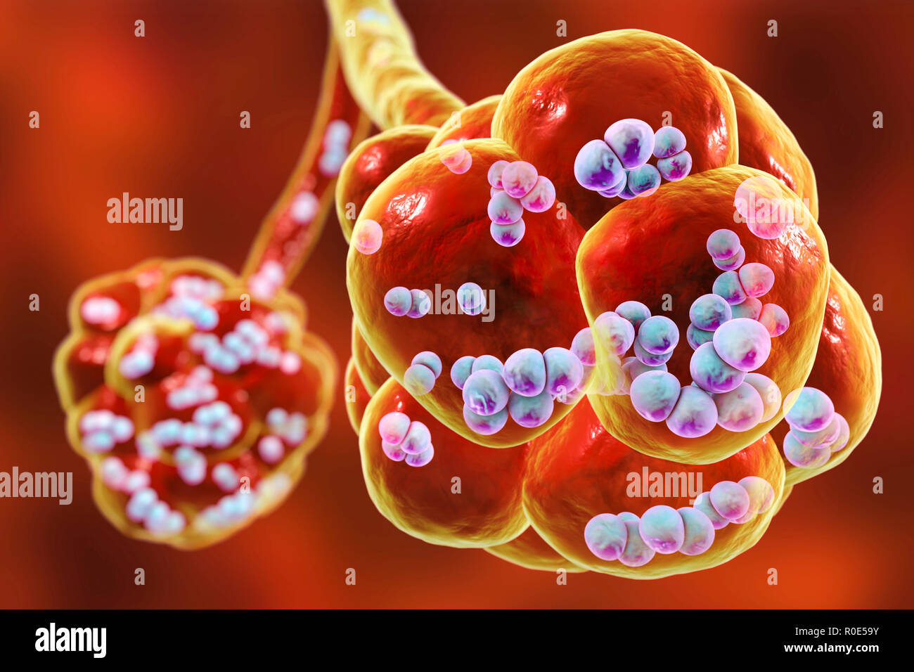 La pneumonie à pneumocoques. Illustration d'ordinateur de Streptococcus ...