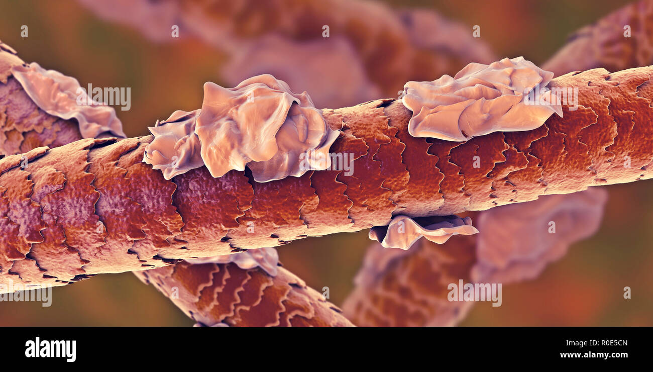 Pityriasis capitis Banque de photographies et d’images à haute ...