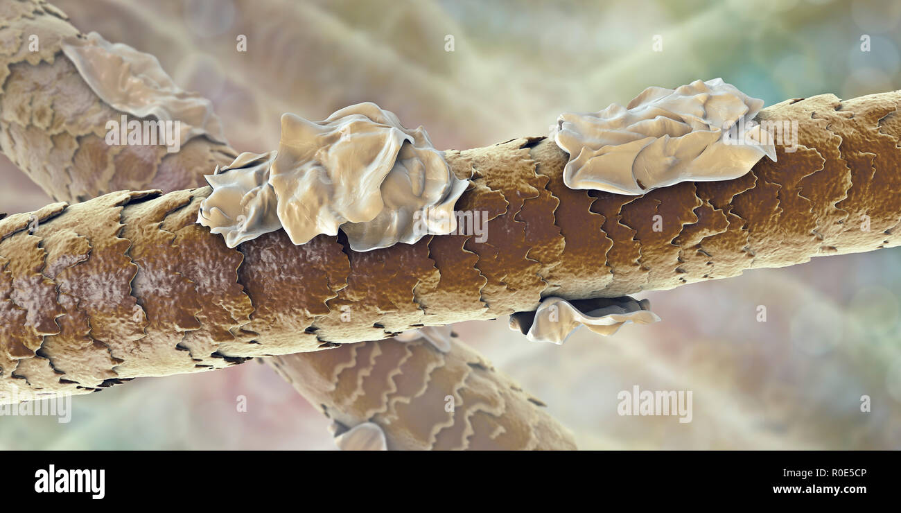 Pityriasis capitis Banque de photographies et d’images à haute ...