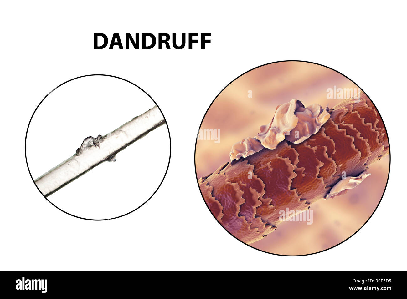 Pityriasis capitis Banque de photographies et d’images à haute ...