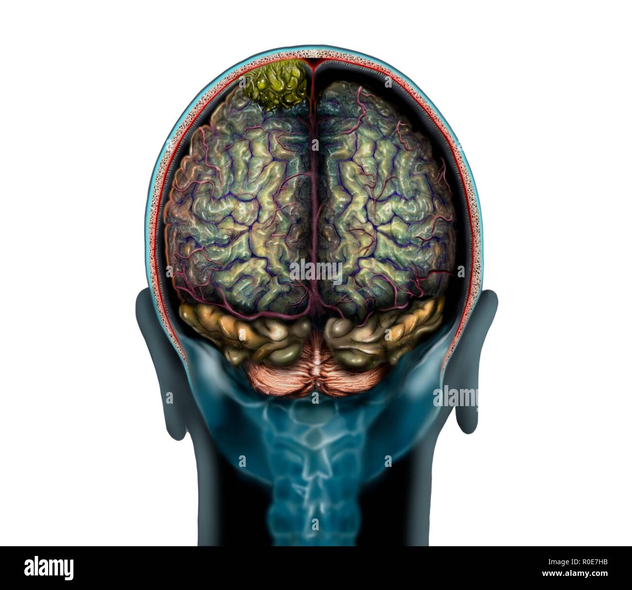 Irm anormal du cerveau Banque de photographies et d’images à haute résolution - Alamy