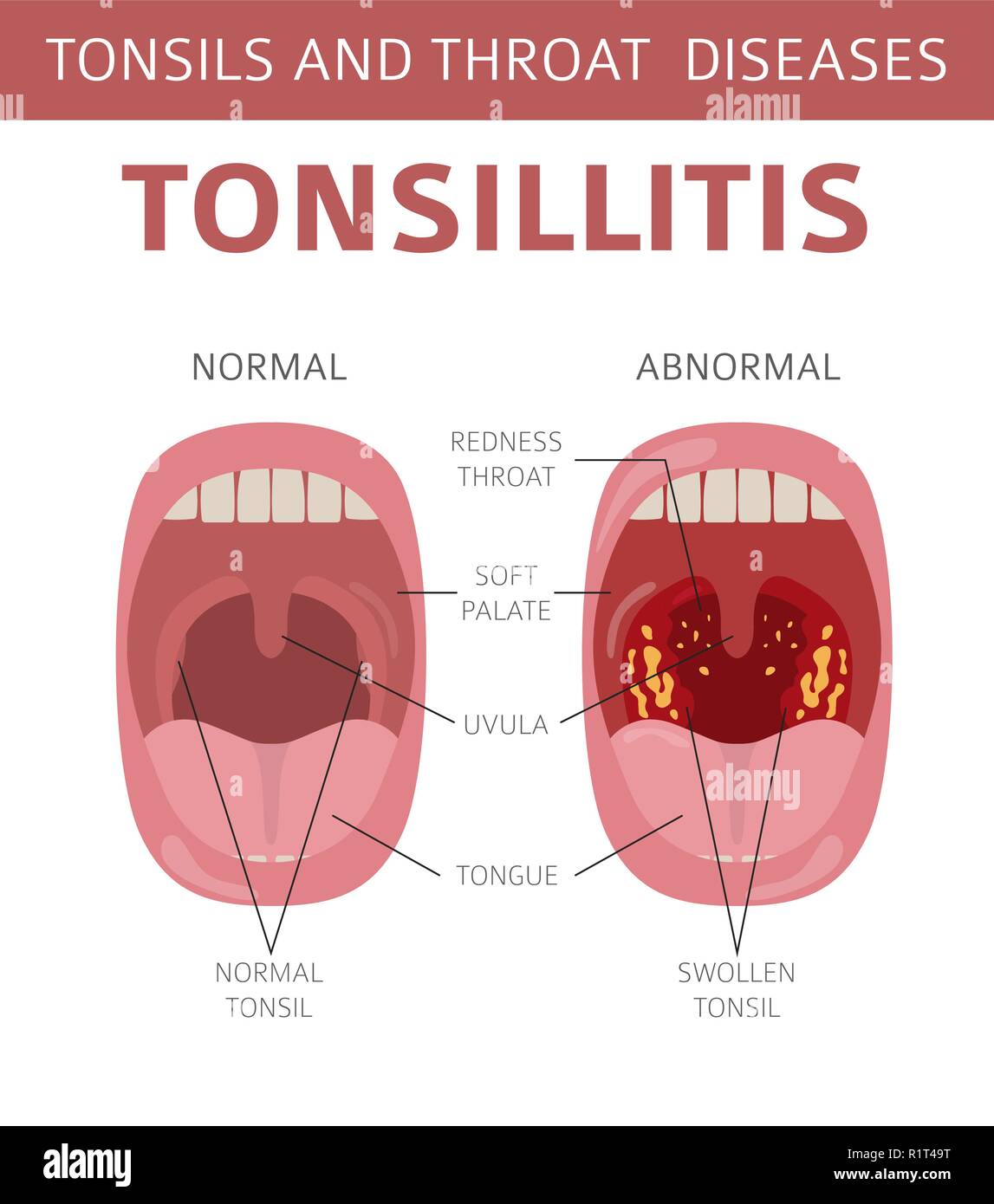 Angine blanche Banque d'images vectorielles - Alamy