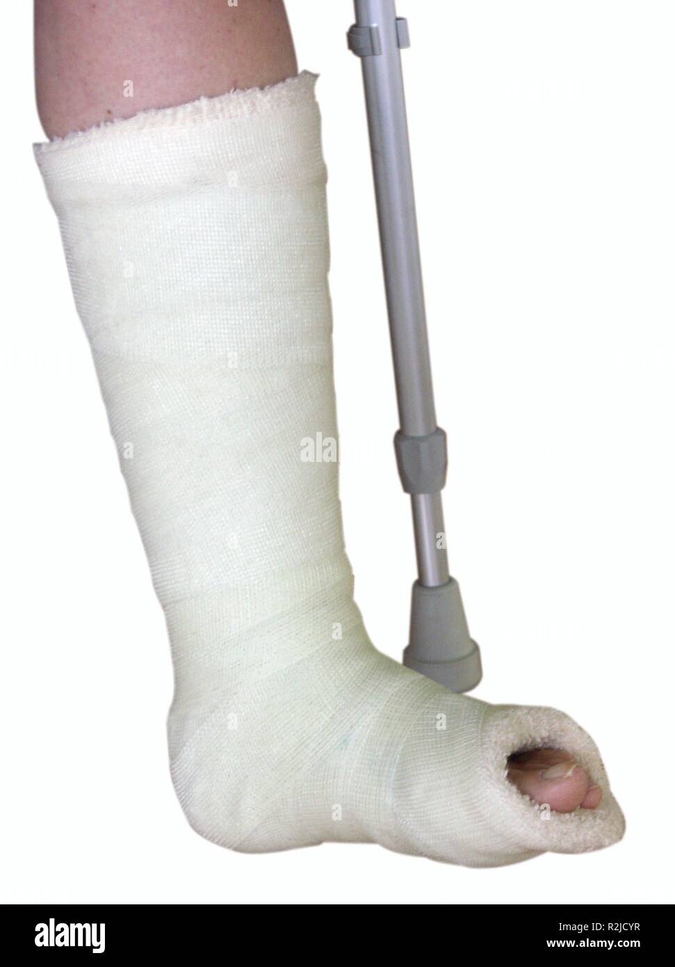 jambe dans le plâtre Photo Stock - Alamy