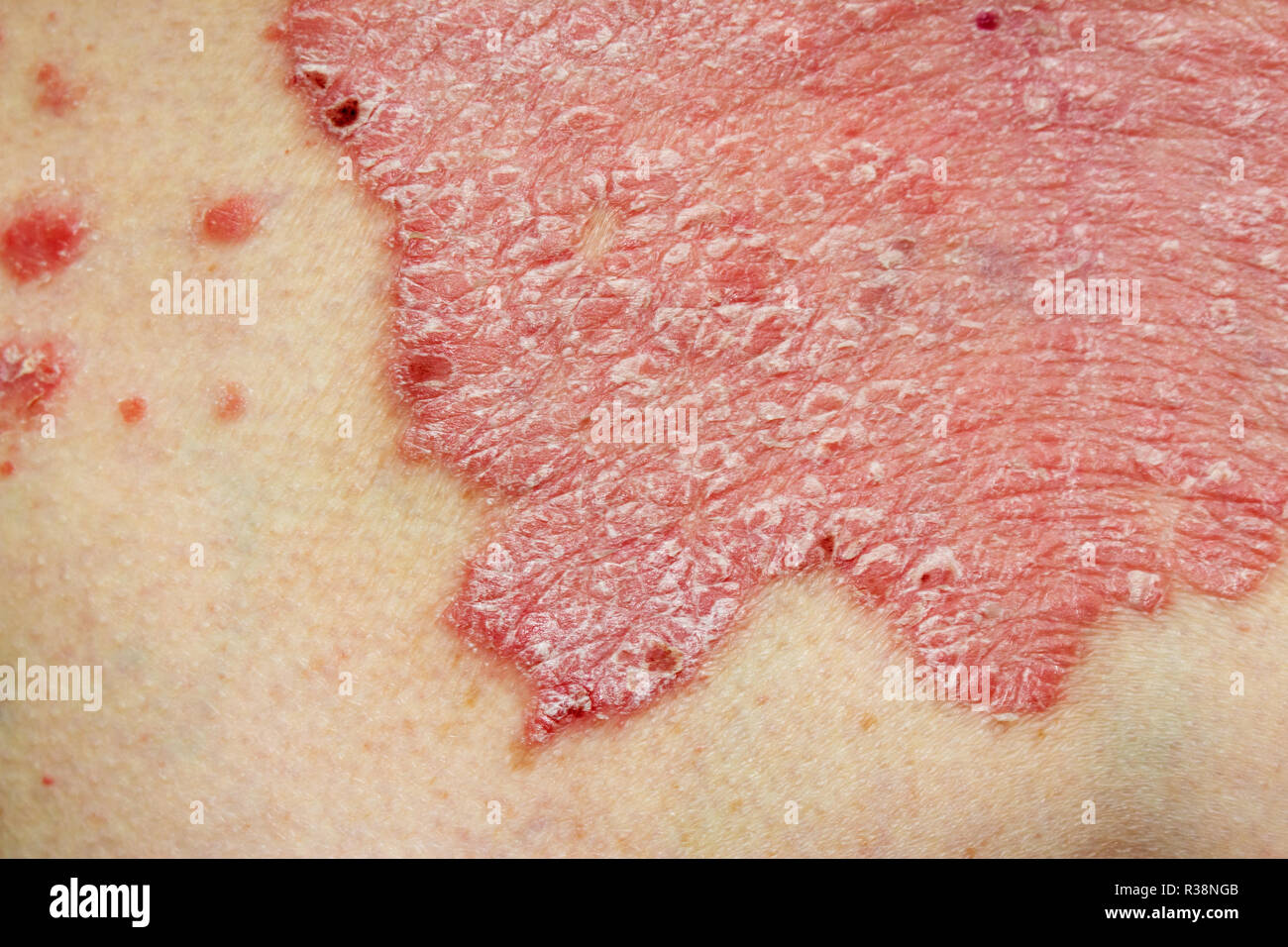 Psoriasis Vulgaris Banque d'image et photos - Alamy