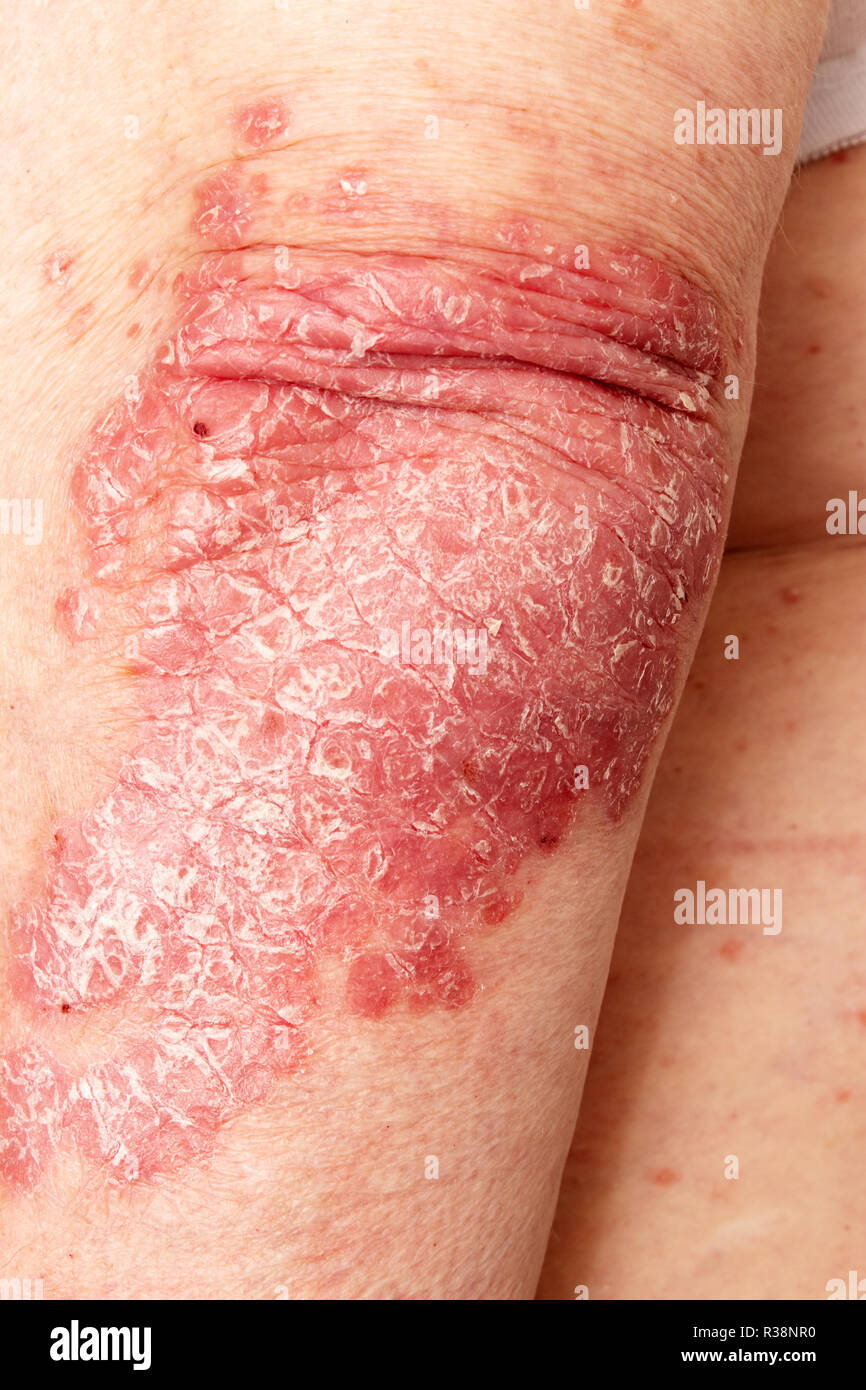 Psoriasis Érythrodermique Banque d'image et photos - Alamy