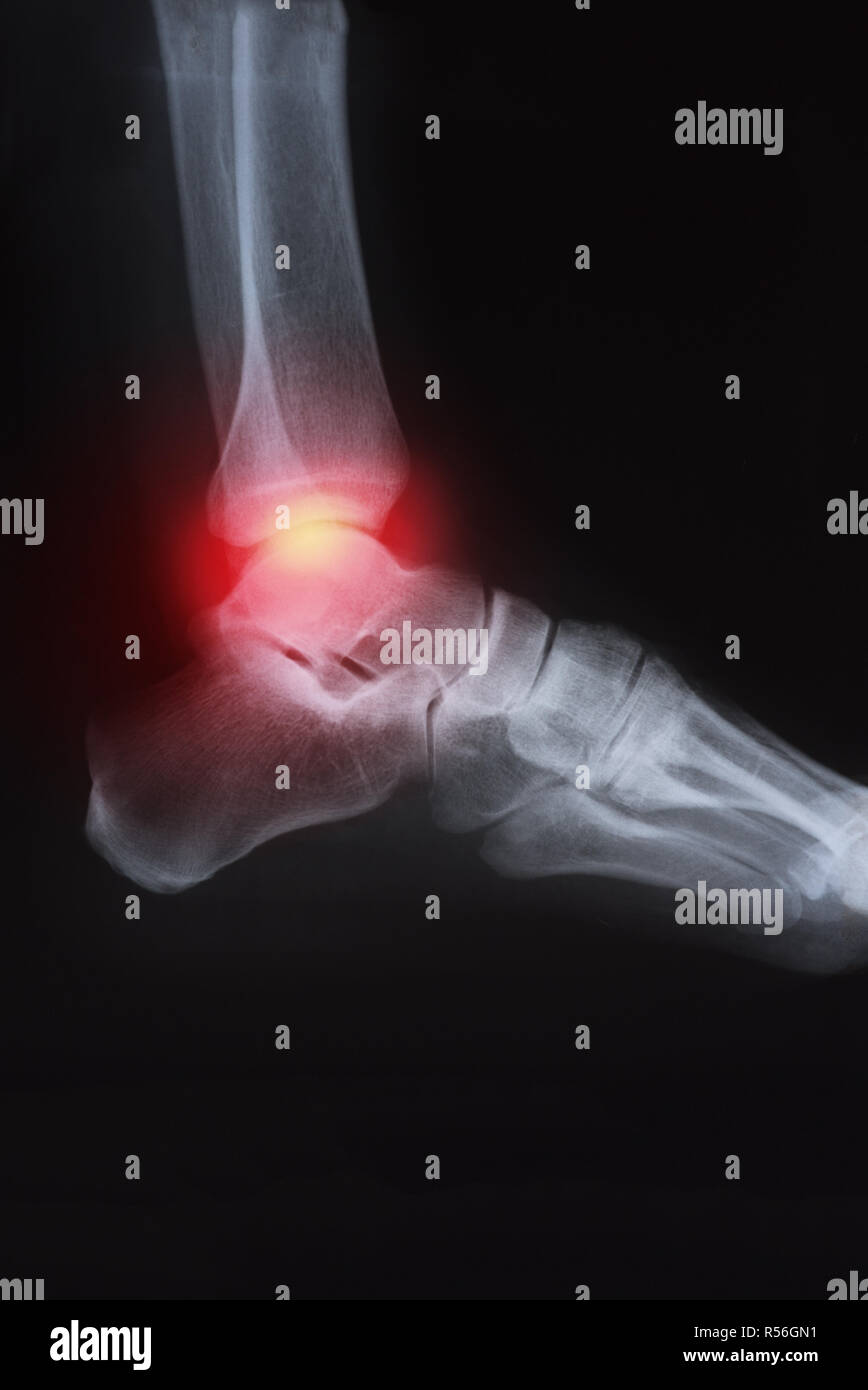Arthrose genou et pieds Banque de photographies et d’images à haute ...