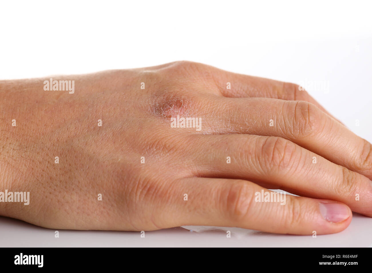 Melanoma scar arm Banque de photographies et d’images à haute ...