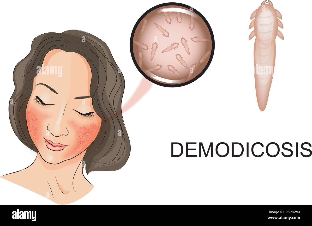 Acarien de visage humain Banque d'images vectorielles - Alamy