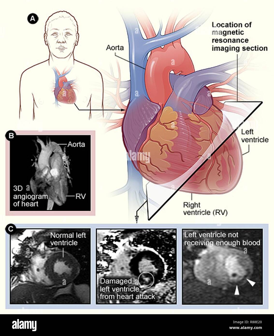Irm cardiaque Banque de photographies et d’images à haute résolution ...